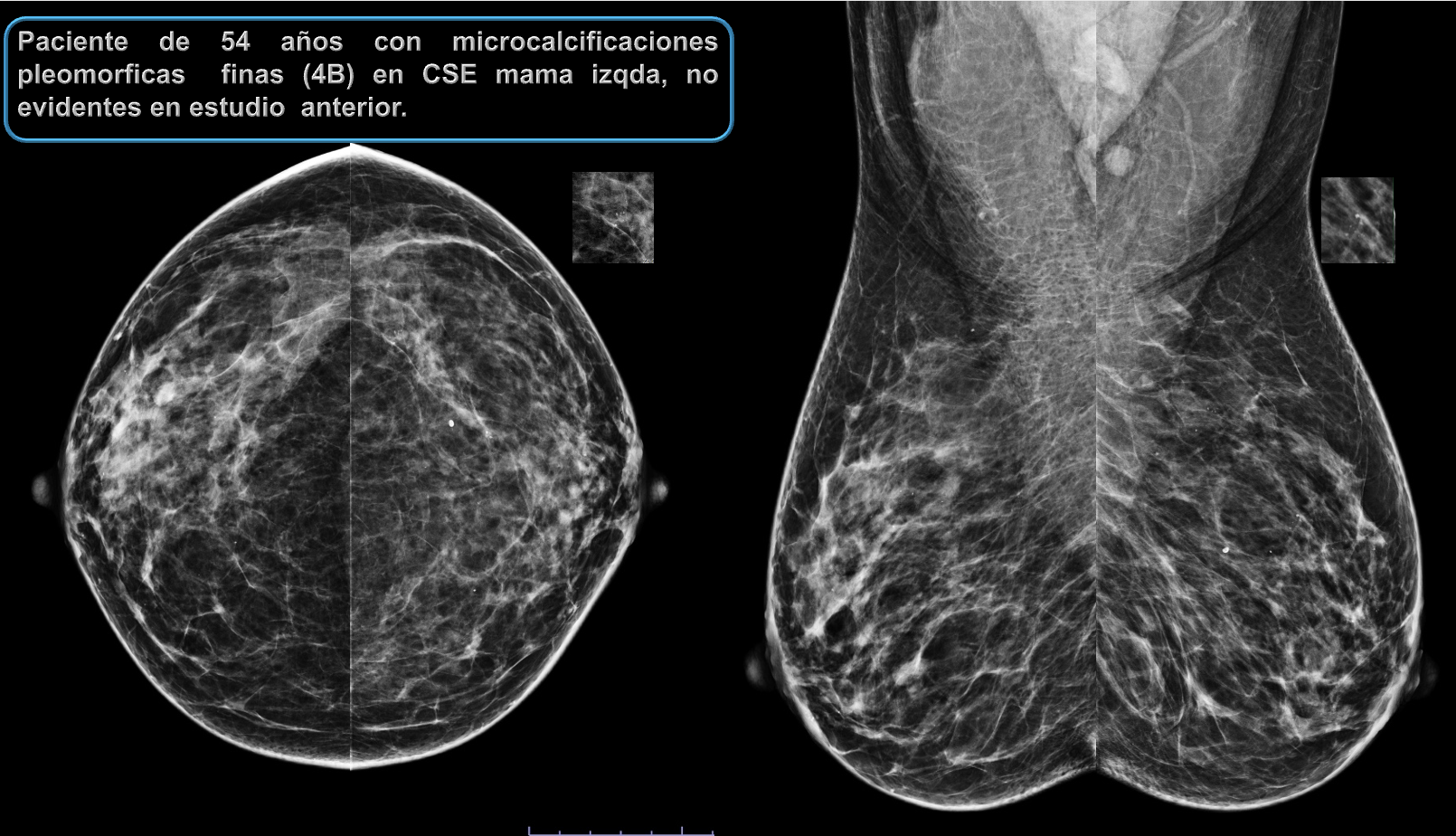 BIOPSIA DE MAMA ASISTIDA CON SISTEMA DE VACIO (B.A.V). - Cerid ...