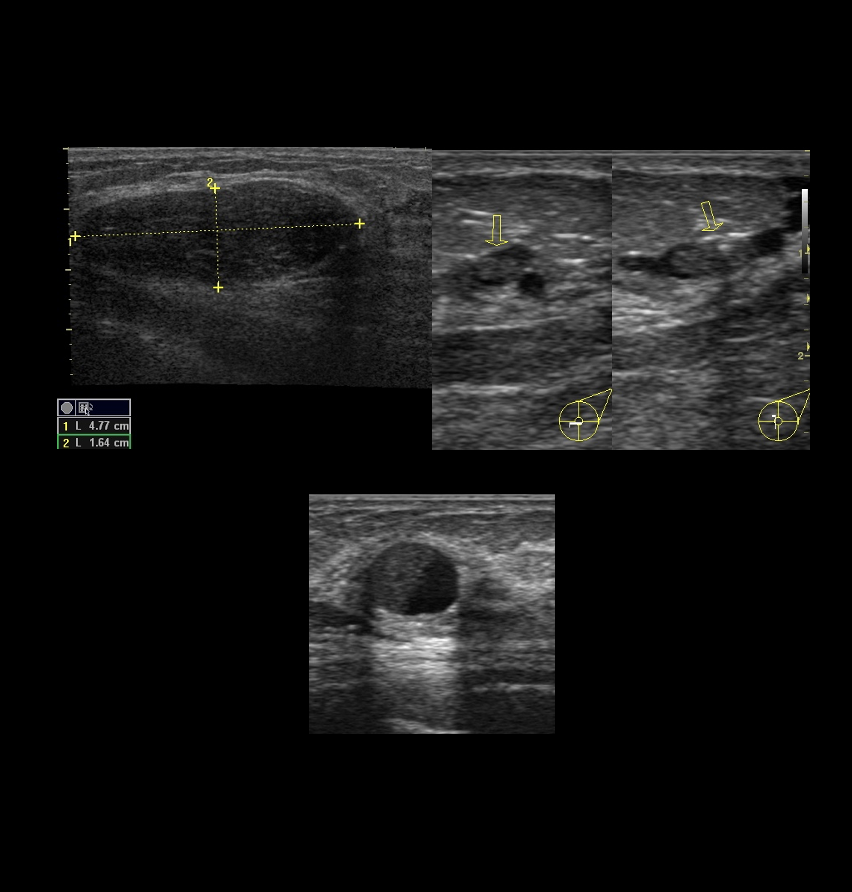 BIOPSIA DE MAMA ASISTIDA CON SISTEMA DE VACIO (B.A.V). - Cerid ...