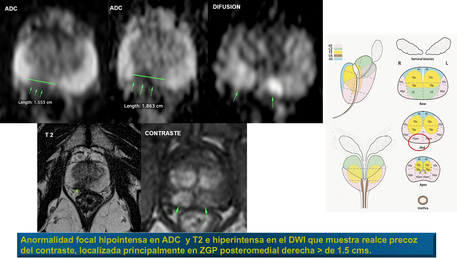 CASO #7 DX. CA. DE PRÓSTATA - Cerid - Imágenes Diagnósticas